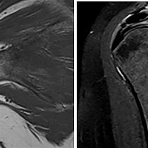 A Usg Image Showing A Normal Subscapularis Tendon B Usg Image Download Scientific Diagram
