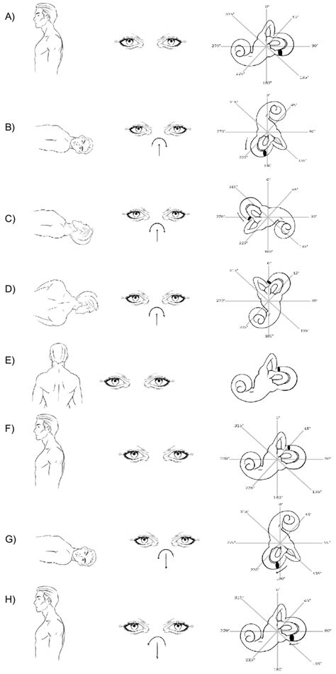 Epley Maneuver Dix Hallpike