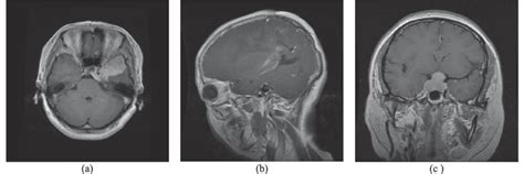 deep multi task learning structure for segmentation and classification of supratentorial brain