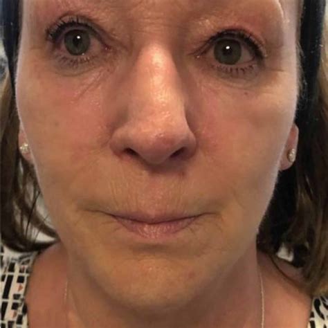 Spring Thread Lift Permanent Facelift Liverpool