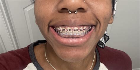 Month 1 Vs Month 8 R Braces