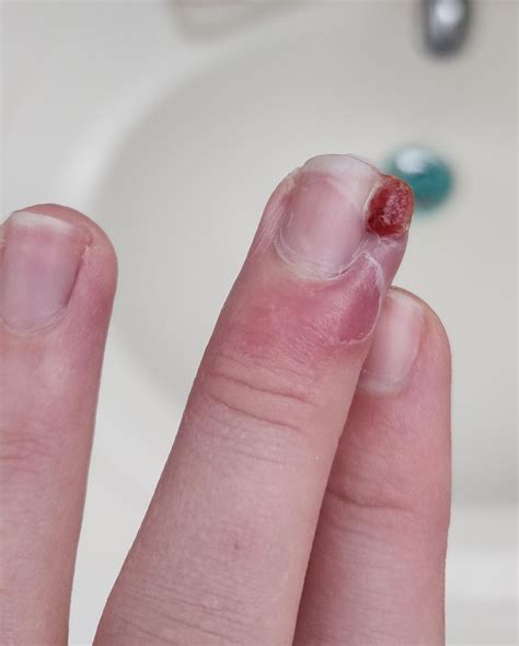 Pyogenic Granuloma Finger Causes