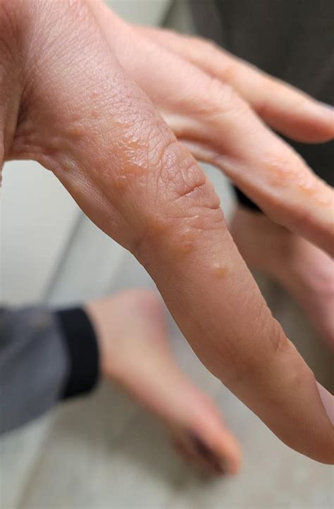 Pompholyx Eczema Causes Symptoms And Treatments How To Get Rid Of