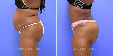 Patient 8522196 Gallery Austin Face And Body