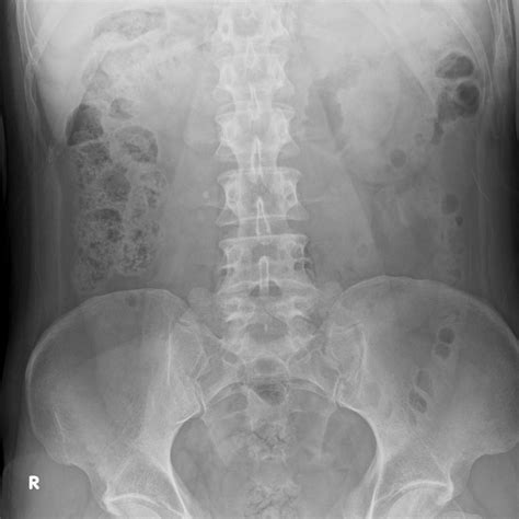 Nephrolithiasis X Ray