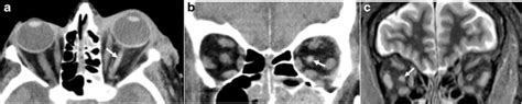 Optic Nerve Trauma A B Optic Nerve Sheath Hematoma Asymmetric