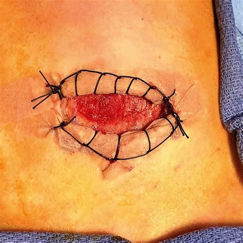 Open Thyroidectomy Clinical Tree