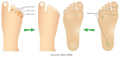 Difference Between Corn And Callus Astonishing Differences Icy Health
