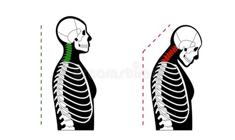 Neck Vertebrae Deformity Stock Vector Illustration Of Medical 274594314