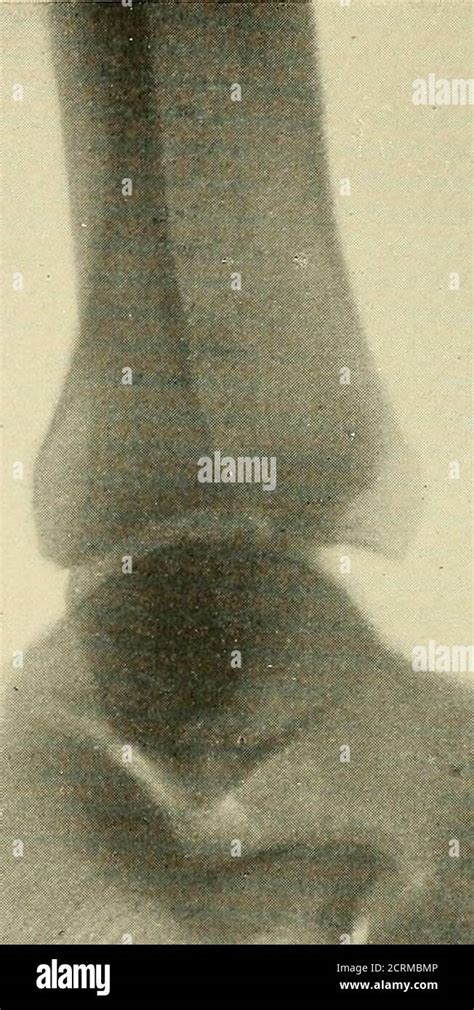 Röntgen Ray Diagnosis And Therapy Fig 13—lateral Dislocation Of