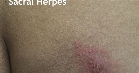 Sacral Herpes Genital Herpes Hsv 2 Presenting On The Buttock By