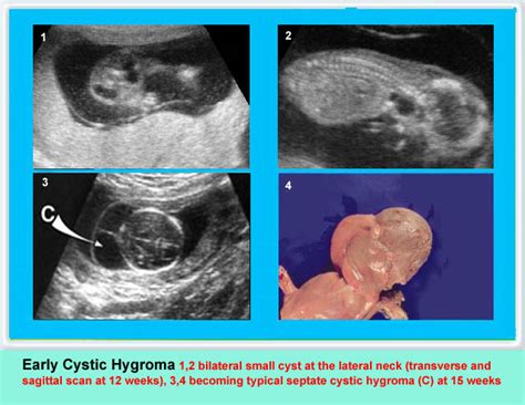 Cystic Hygroma Department Of Obstetrics And Gynecology Faculty Of