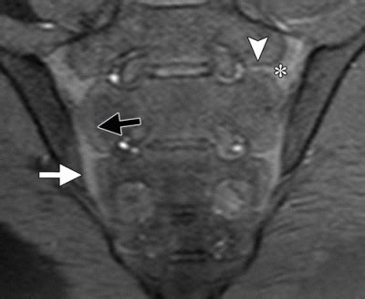 Ressonancia Magnetica De Espondilite Anquilosante Ankylosing