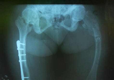 Rehabilitation After Girdlestone Surgery Muvzmj
