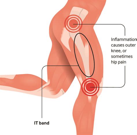 Iliotibial Band Syndrome Symptoms