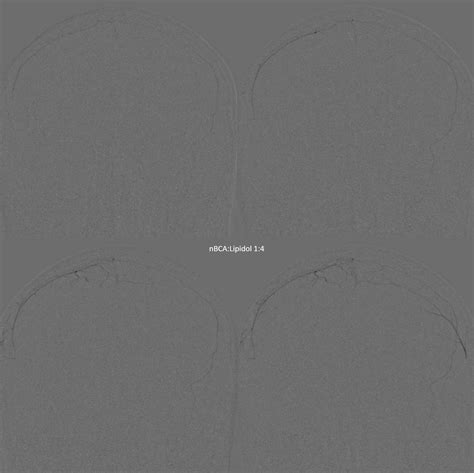 Mma Embolization Post Craniotomy Contralateral Reconstitution