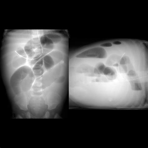 Ileocecal Intussusception Pacs