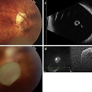 Pdf Floating Vitreous Cyst Two Clinical Cases