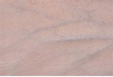Reticular Veins Vs Telangiectasia Spider Veins Australia