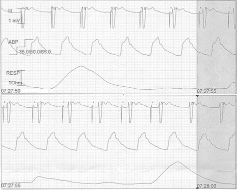 Pedi Cardiology Quiz Temporary Pacemaker