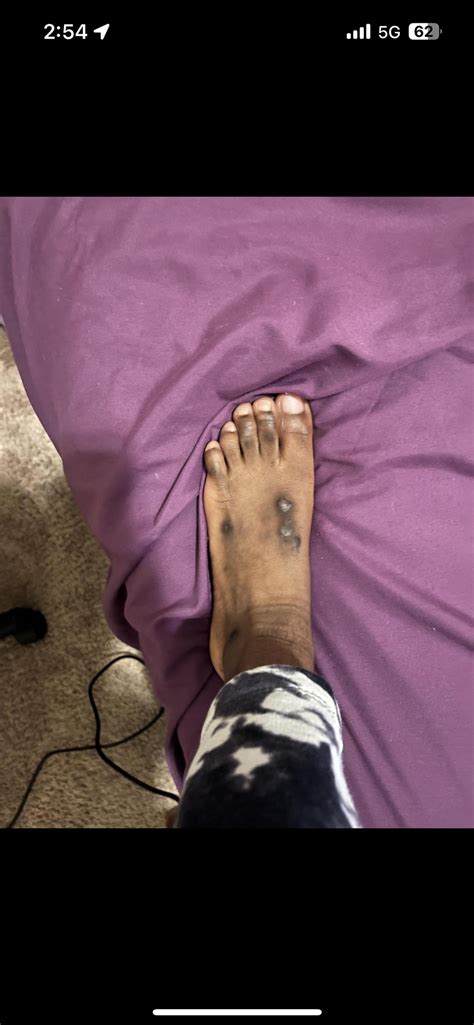 Any Advice For Getting Rid Of These Bug Bite Scars R Skincareaddicts