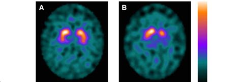 Dat Spect Imaging Normal A And Abnormal B [ 123 I]fp Cit Spect Download Scientific Diagram