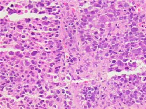 Hcc Solid Growth Pattern Considerable Nuclear Pleomorphism And Download Scientific Diagram
