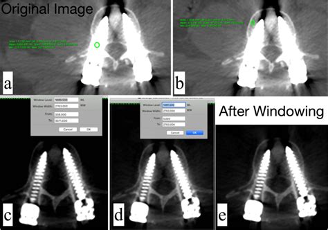 Methods To Address Metal Artifacts In Post Processed Ct Images A Do