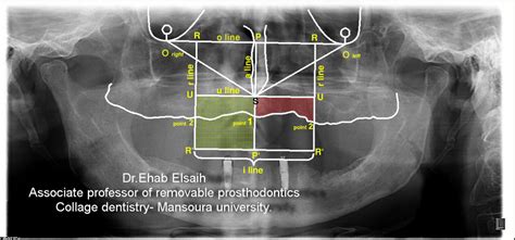 Pdf Anterior Maxillary Resorption