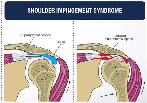 Star Physical Therapy What Is Shoulder Impingement
