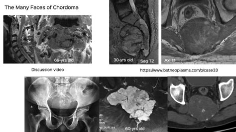 Bhavin Jankharia On Linkedin Case 33 A Mushrooming Sacral Tumor