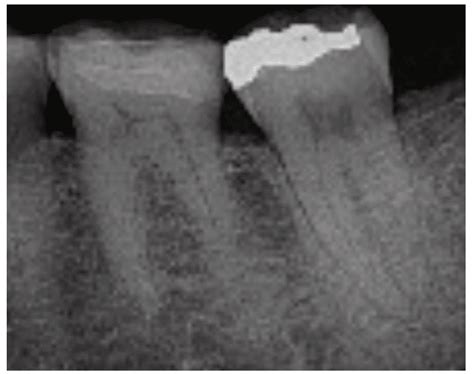 Cracked Teeth — How To Detect For The Best Prognosis