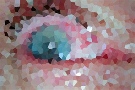 Atopic Keratoconjunctivitis Akc College Of Optometrists