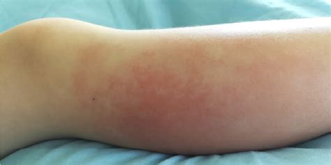 Cellulitiserysipelas Initial Assessment Mims Singapore