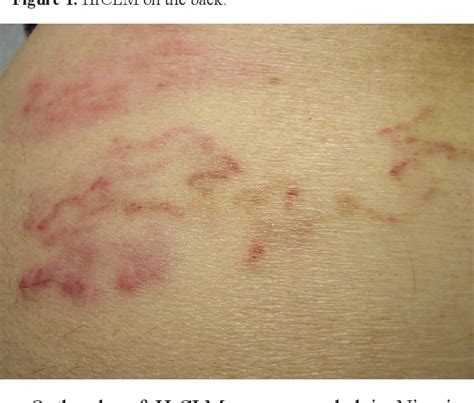 Hookworm Skin Infection