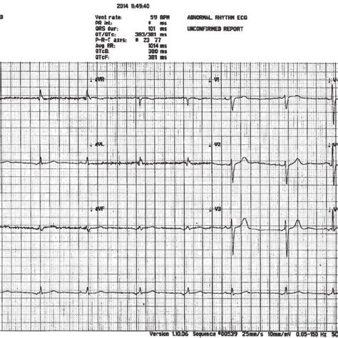 Pdf Electrocardiogram Quiz Case 22 Wandering Atrial Pacemaker