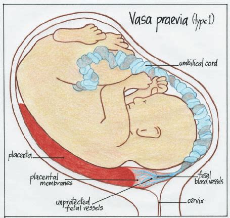 Vasa Previa Typе 2 17 нед