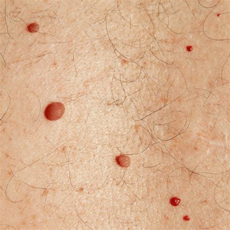 Cherry Angioma Causes And Treatment At Keith Maxey Blog
