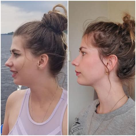 Overbite Before And After Artofit