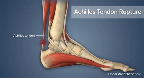 Achilles Tendon Failed Achilles Tendon Surgery