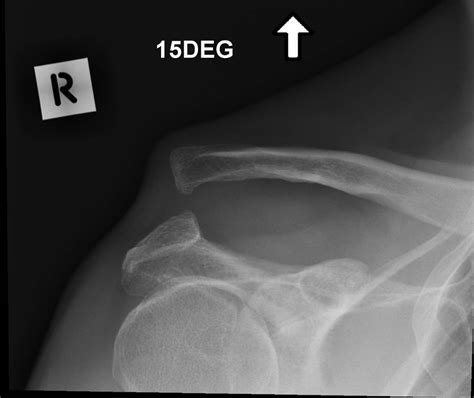 Ac Jt Type V The Emergency Physio