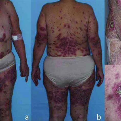Clinical Presentation Of The Patient On Admission Scattered Pustules