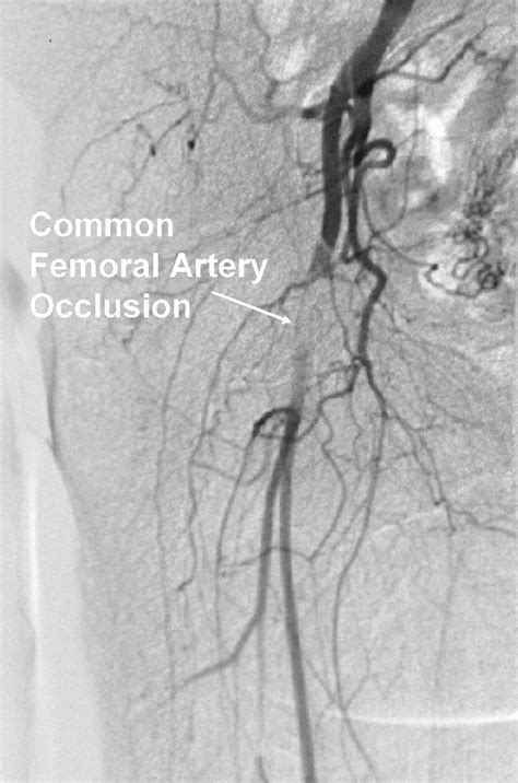 Posterior Wall Capture And Resultant Common Femoral Occlusion