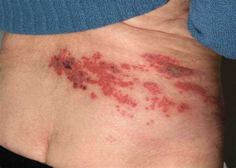 Viral Rashes Contagious Viral Rashes Causes Symptoms And Treatment