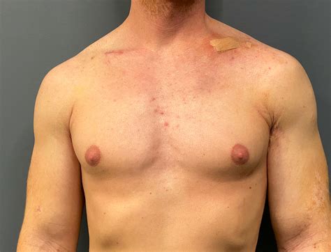 Male Clavicle Lengthenng Results 6 Weeks Front 2 Dr Barry Eppley Explore Plastic Surgery