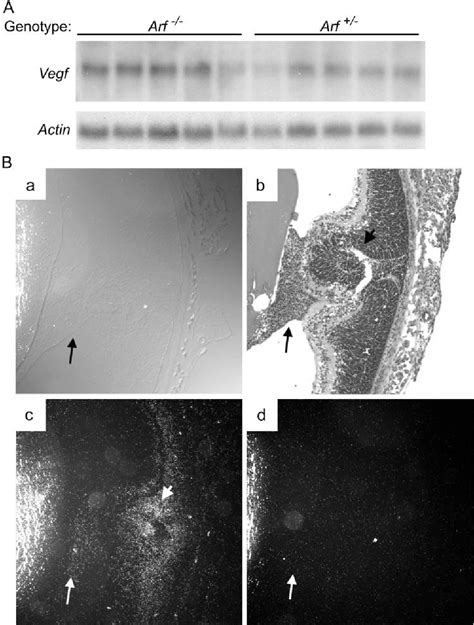 Figure 1 From Pathogenesis Of Persistent Hyperplastic Primary Vitreous