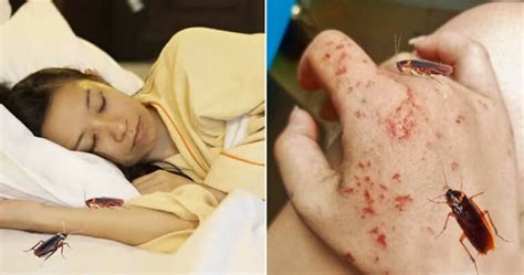 Womans Hand Bitten By Cockroach While Sleeping Most Likely Caused By