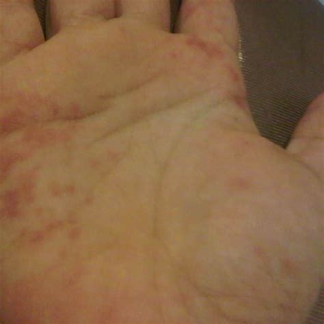 Figure A Multiple Painful Ill Defined Border Reticulated