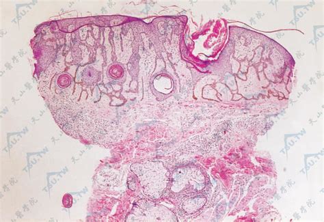 【附图】 纤维上皮瘤 皮肤病学 天山医学院