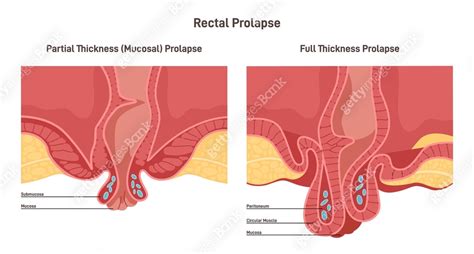 Rectum Prolapse Two Types Of Proctological Disease Human Anus 이미지
